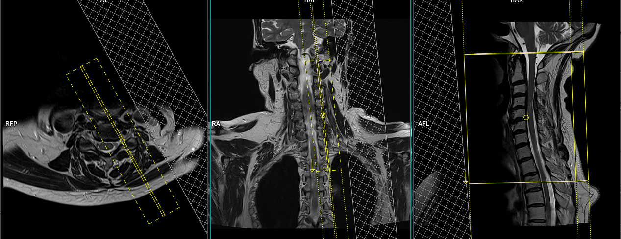 MRI cervical spine exit forearm view