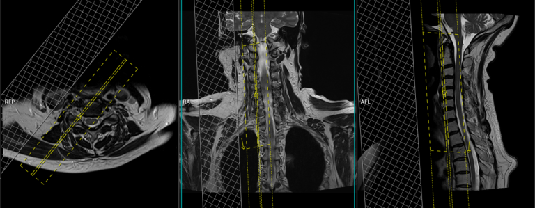 MRI cervical spine exit forearm view