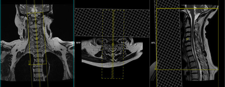 MRI cervical spine exit forearm view