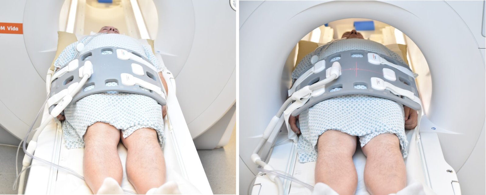 MRI Arthrogram Hip Protocol and Planning | Indications for MRI ...