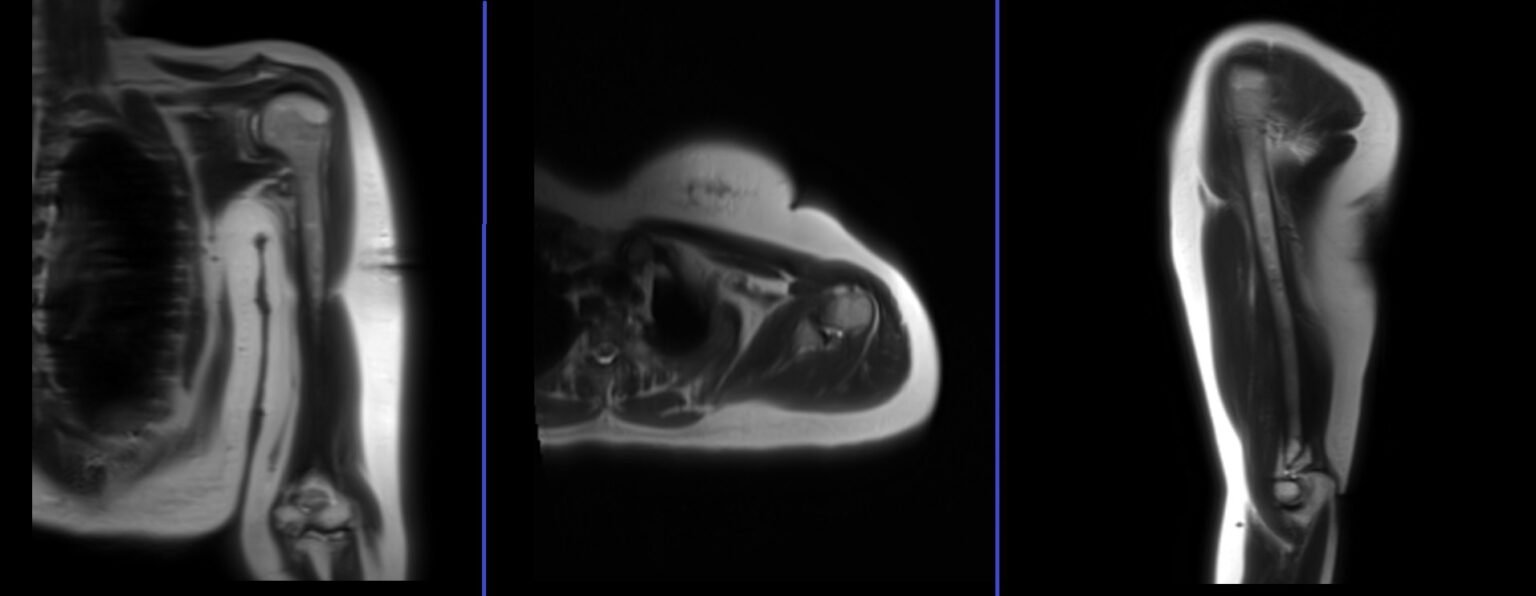 Humerus (Upper arm) MRI Protocols and Planning | Indications for MRI ...