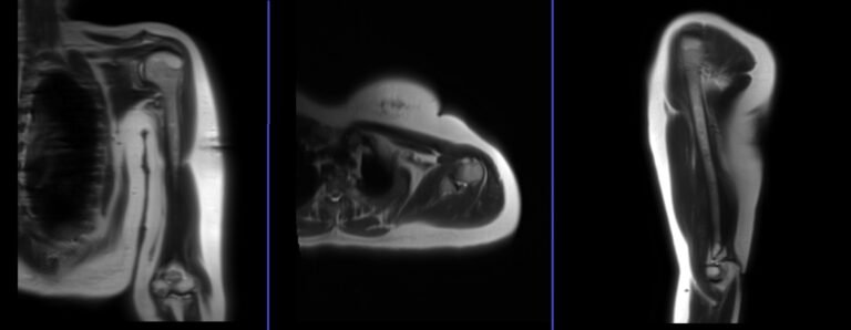 Humerus (Upper arm) MRI Protocols and Planning | Indications for MRI ...