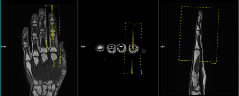 MRI index finger | MRI index finger protocol and planning