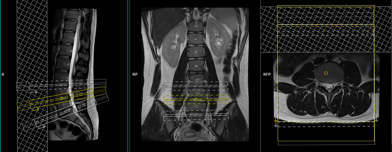 lumbar spine exit forearm view | mri lumbar spine exit forearm view ...