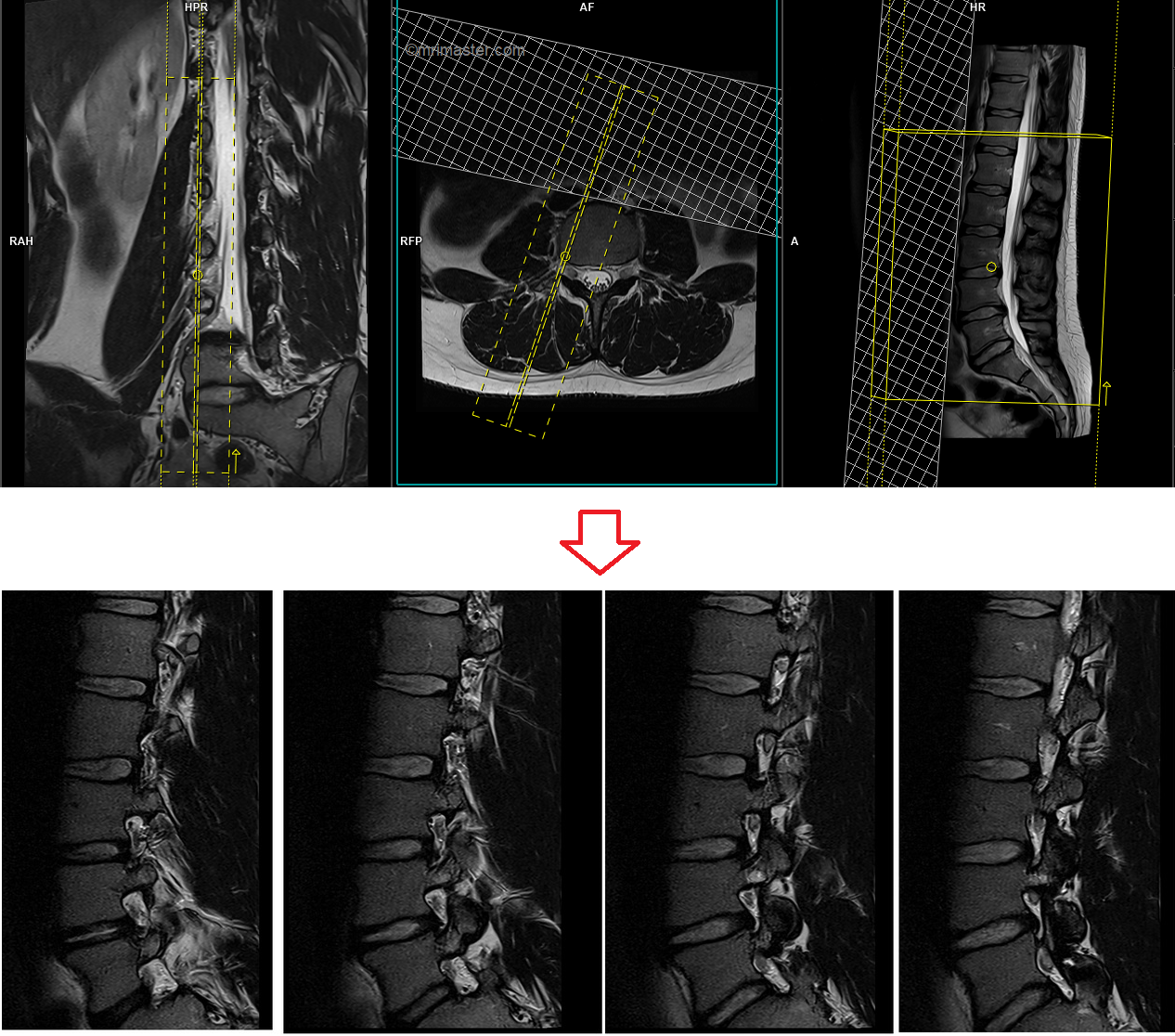 lumbar spine exit forearm view | mri lumbar spine exit forearm view ...