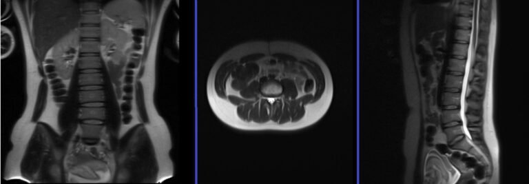 lumbar spine exit forearm view | mri lumbar spine exit forearm view ...