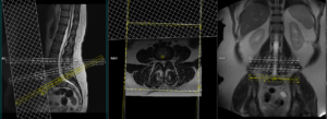Lumbar (lumbosacral) Spine MRI Planning and Protocols | Indications for ...