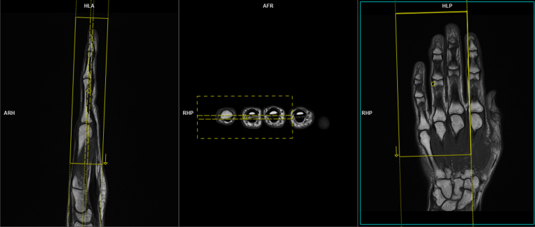 MRI ring finger | MRI ring finger protocol, positioning and planning