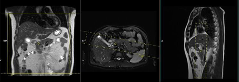 Secretin Stimulated MRCP Planning and Protocols| Indications for ...