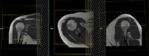MRI shoulder arthrogram protocols and planning | Indications for MRI