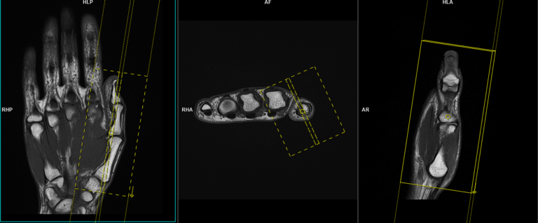 MRI thumb | MRI thumb protocol and planning