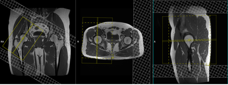 MRI Arthrogram Hip Protocol and Planning | Indications for MRI ...