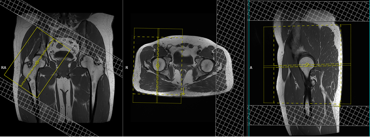 Mri Arthrogram Hip Protocol And Planning Indications For Mri Arthrogram Hip Scan