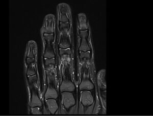 STIR MRI sequence | Physics, pathology and image appearance