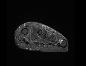 STIR MRI sequence | Physics, pathology and image appearance