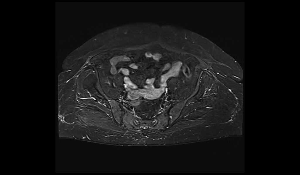 STIR MRI sequence | Physics, pathology and image appearance