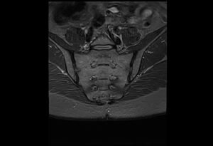 STIR MRI sequence | Physics, pathology and image appearance