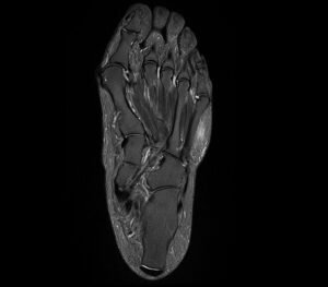STIR MRI sequence | Physics, pathology and image appearance