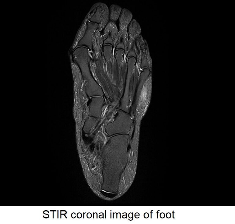 STIR MRI sequence | Physics, pathology and image appearance