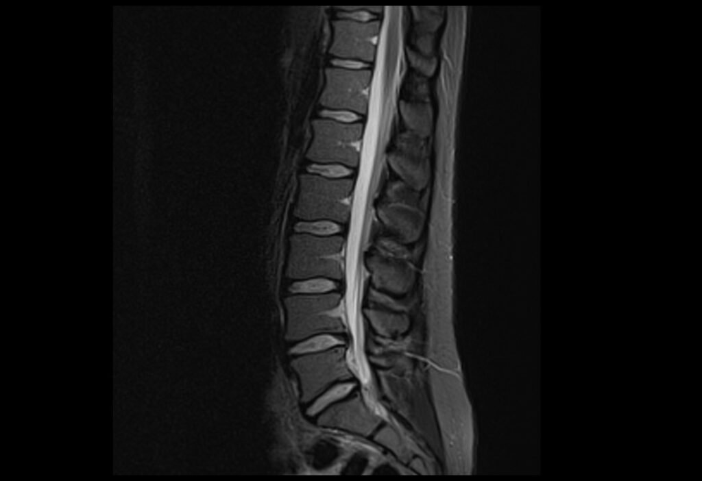 STIR MRI sequence | Physics, pathology and image appearance