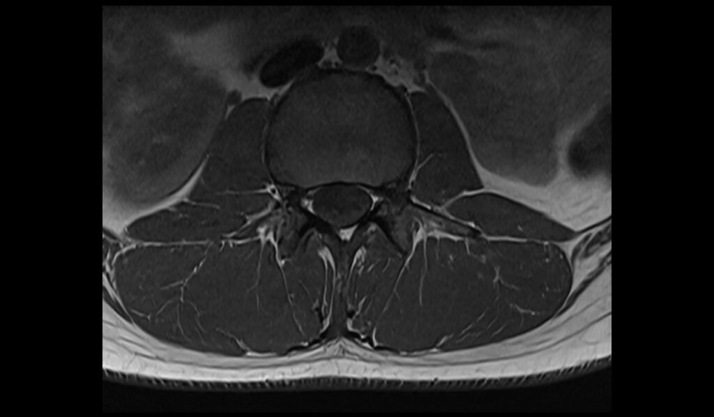 T1 MRI | MRI T1 weighted sequences
