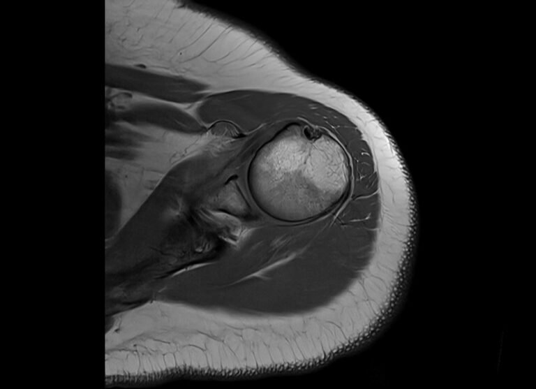 T1 MRI | MRI T1 weighted sequences