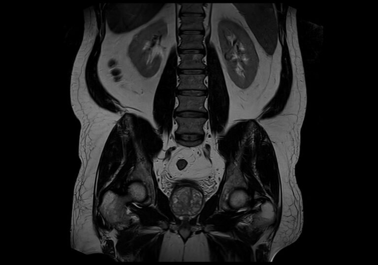 T2 MRI | T2 weighted MRI sequence physics and image appearance