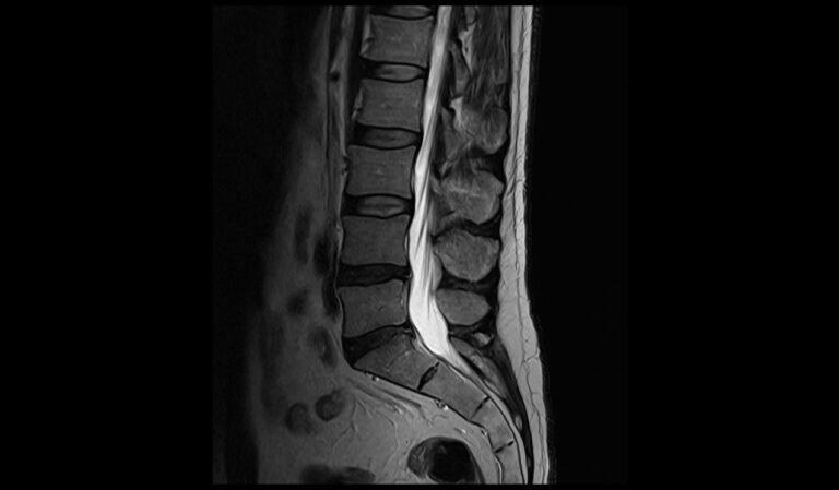 T2 MRI | T2 weighted MRI sequence physics and image appearance