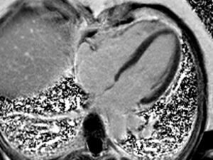 Cardiac MRI PSIR delayed 4CH images