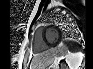 Cardiac MRI PSIR delayed short axis images