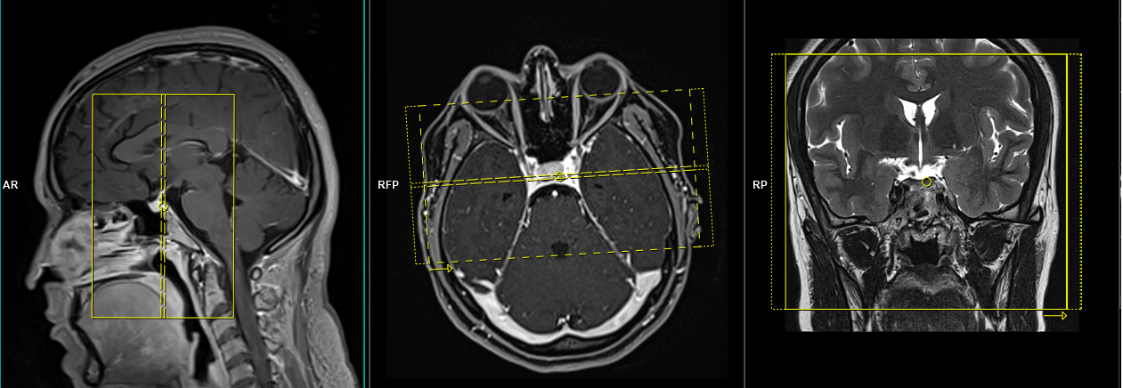 Cavernous Sinus MRI | MRI Cavernous Sinus Protocol and Planning