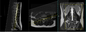 lumbar spine exit forearm view | mri lumbar spine exit forearm view ...
