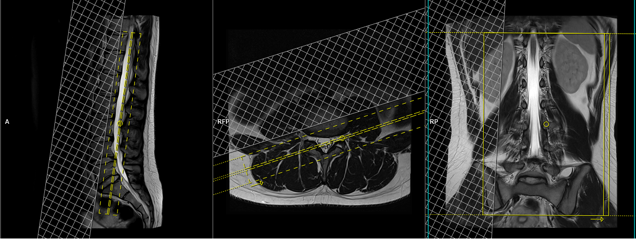 lumbar spine exit forearm view | mri lumbar spine exit forearm view ...