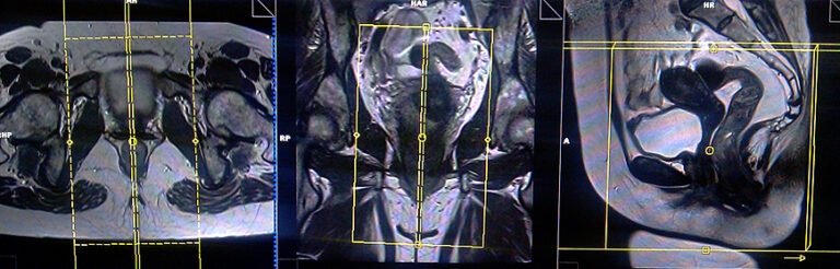 anovaginal and rectovaginal fistula mri normal variation - mrimaster