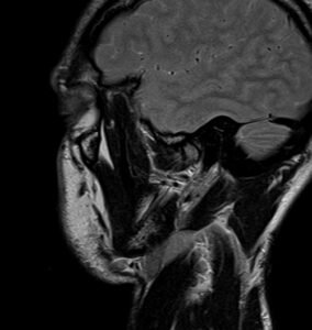 MRI face T2 sagittal images