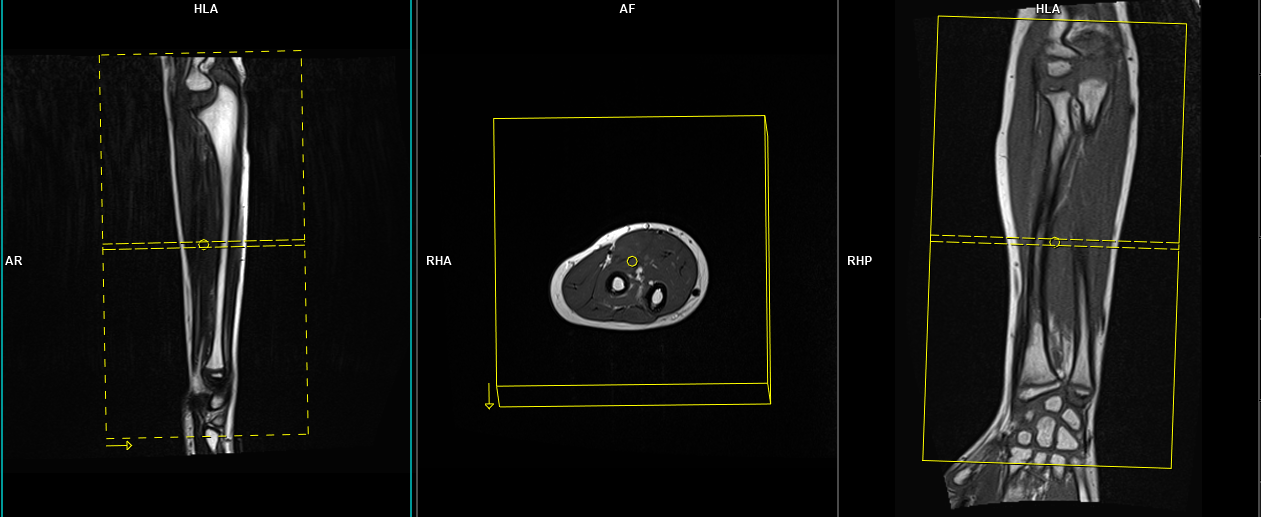 Forearm MRI Protocols and Planning | Indications for MRI Forearm ...