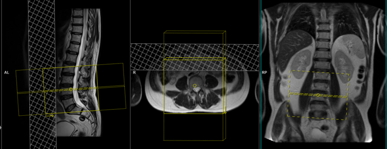MRI whole spine | MRI whole spine protocol and planning