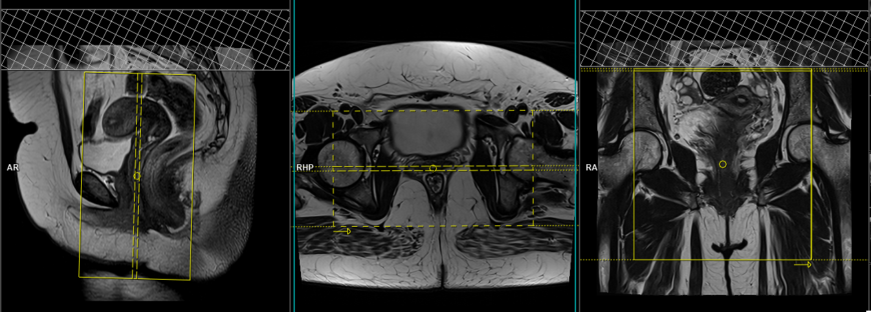 MRI recto-veginal fistula planning | MRI RV fistula protocols ...