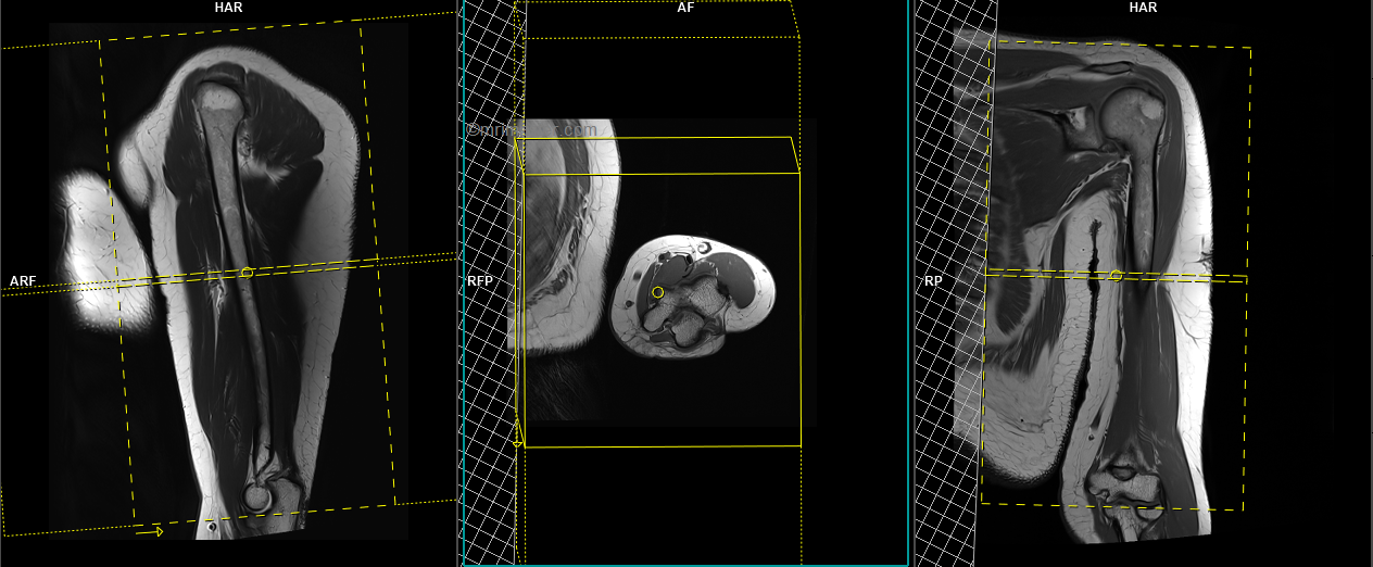 Humerus (Upper arm) MRI Protocols and Planning | Indications for MRI ...