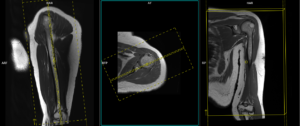 Humerus (Upper arm) MRI Protocols and Planning | Indications for MRI ...