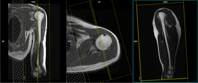 Humerus Upper Arm Mri Protocols And Planning Indications For Mri Humerus Scan