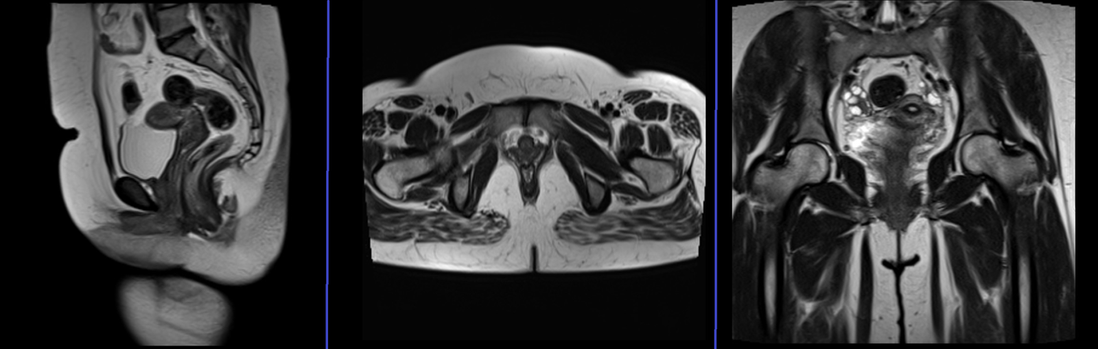 MRI recto-veginal fistula planning | MRI RV fistula protocols ...