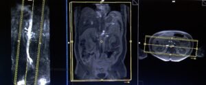 MRA Legs (Peripheral MRA) Protocols and Planning | Indications for ...