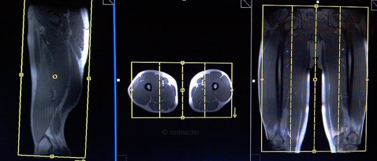 MRA Legs (Peripheral MRA) Protocols and Planning | Indications for ...