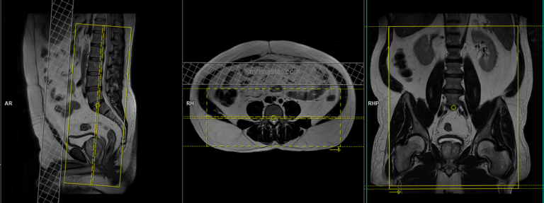 Lumbosacral Plexus MRI Protocols and Planning | Indications for MRI ...