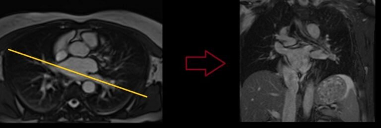 Cardiac MRI Flow Quantification Protocols, Planning and Techniques