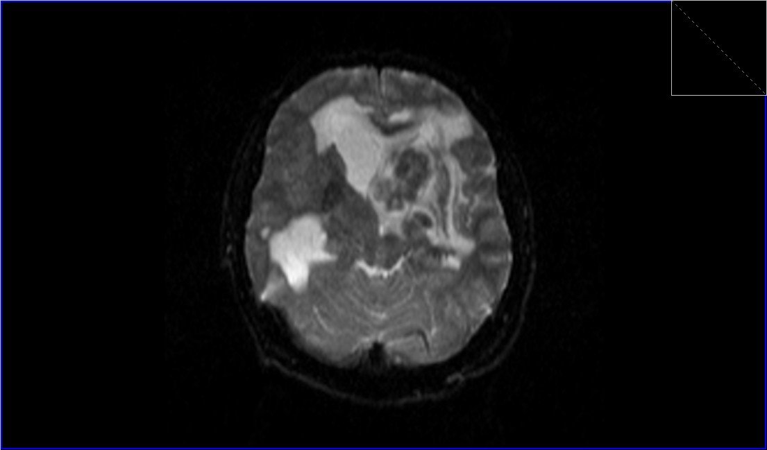 Central nervous system tuberculosis(TB) MRI