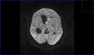 Central nervous system tuberculosis(TB) MRI