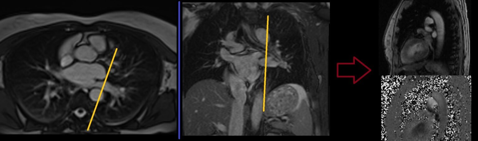 Cardiac MRI Flow Quantification Protocols, Planning and Techniques