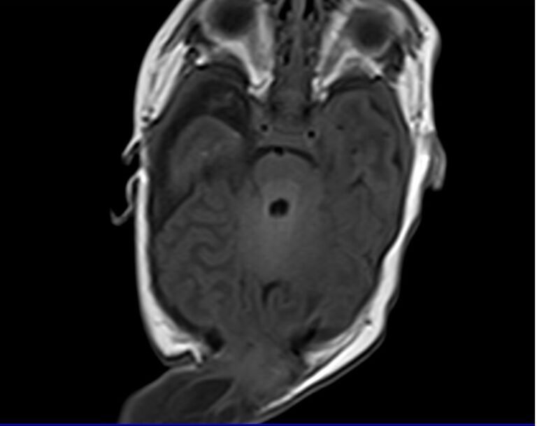 Meningoencephalocele MRI